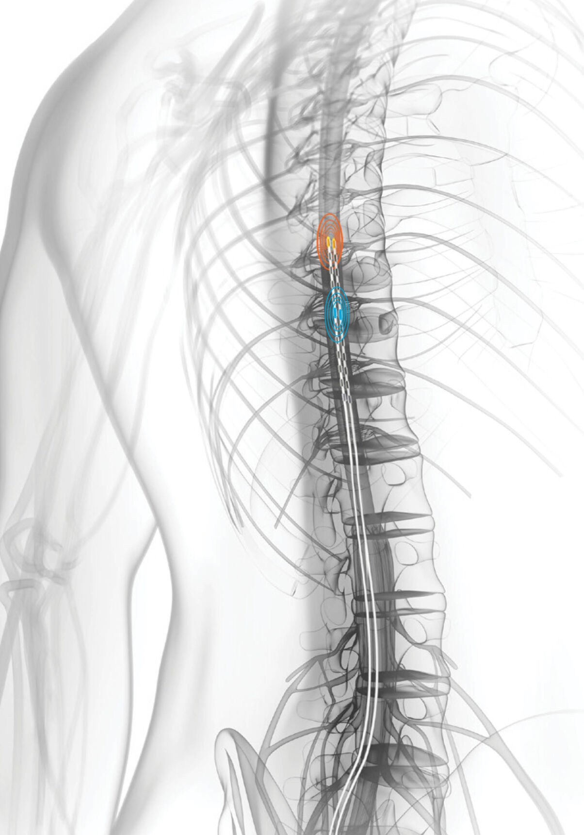 AI spine stimulator relieves back pain for Louisianans | Louisiana ...