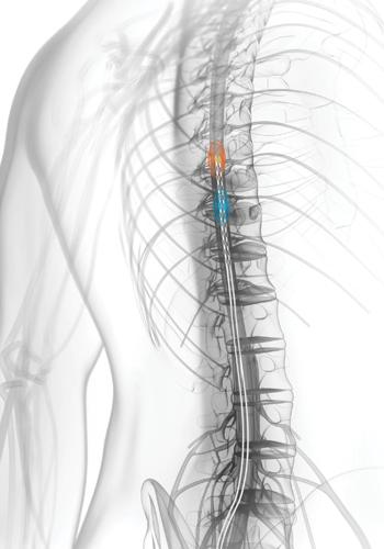 AI spine stimulator relieves back pain for Louisianans | Louisiana ...