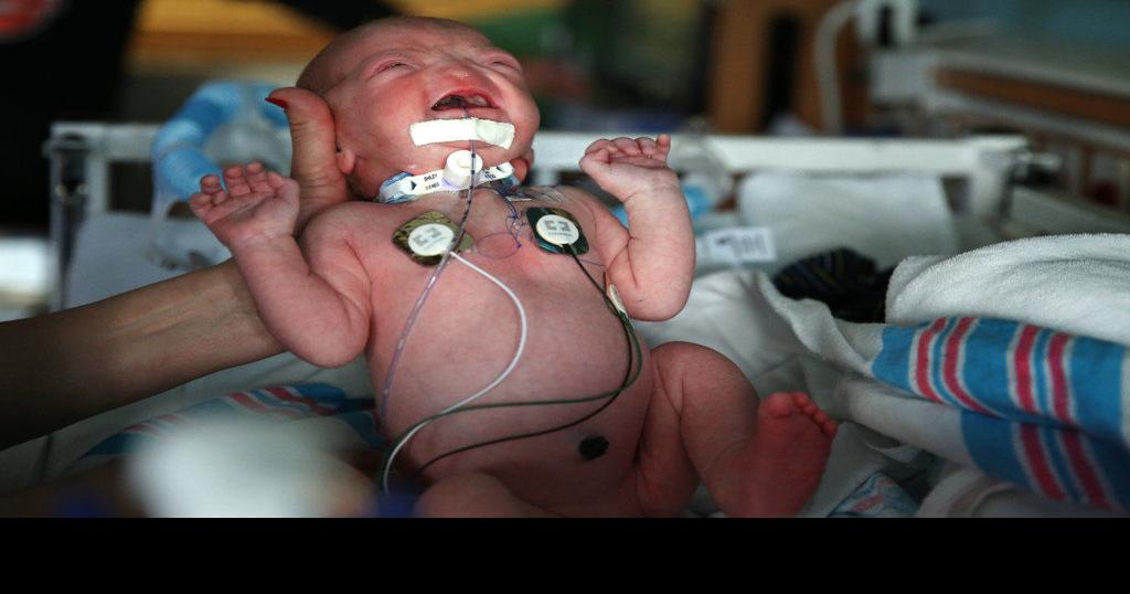 Miracle baby born without a nose in Alabama is 1 in 197,000,000 | News ...