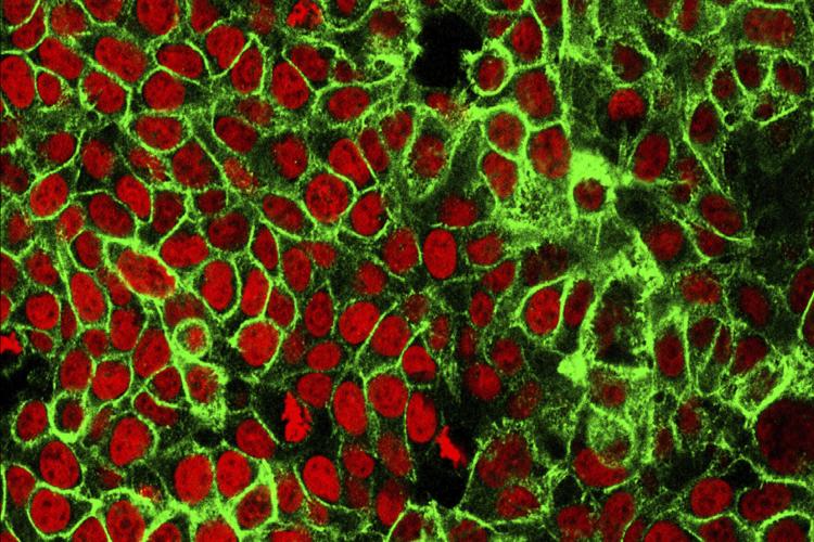 Louisiana's connection with colon cancer | Louisiana Health | nola.com