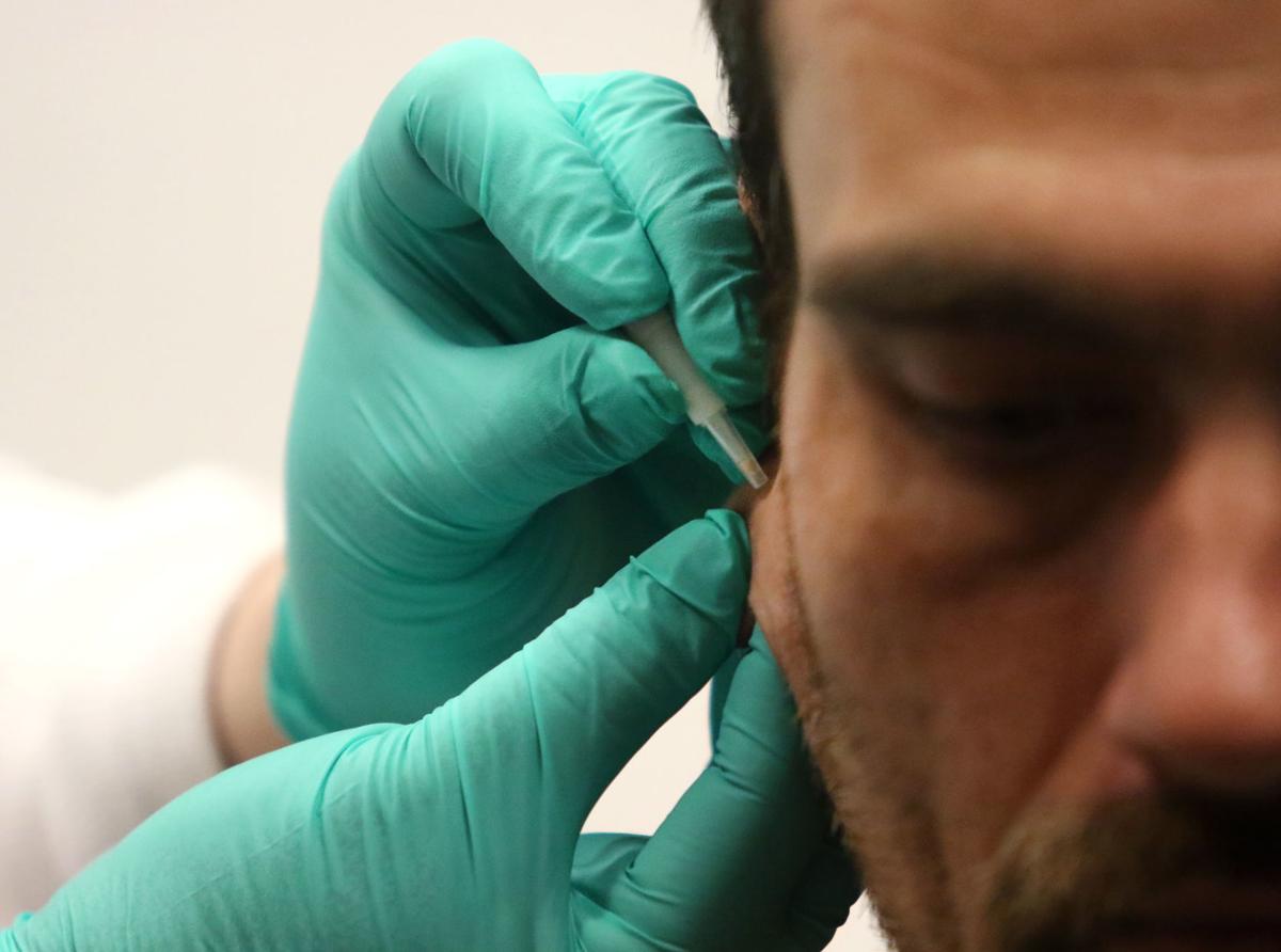 Battlefield acupuncture gives veterans alternative to drugs for pain ...