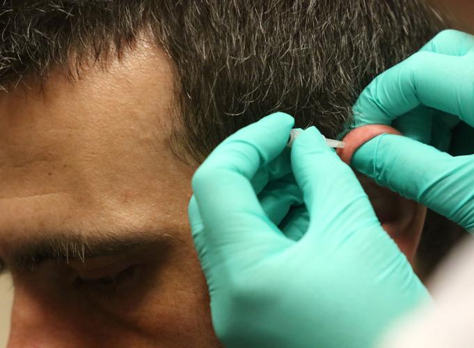 Battlefield acupuncture gives veterans alternative to drugs for pain ...