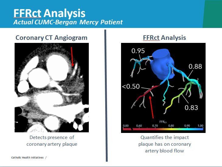 CHI Health helps with trial showing CT, flow analysis better for assessing blockages