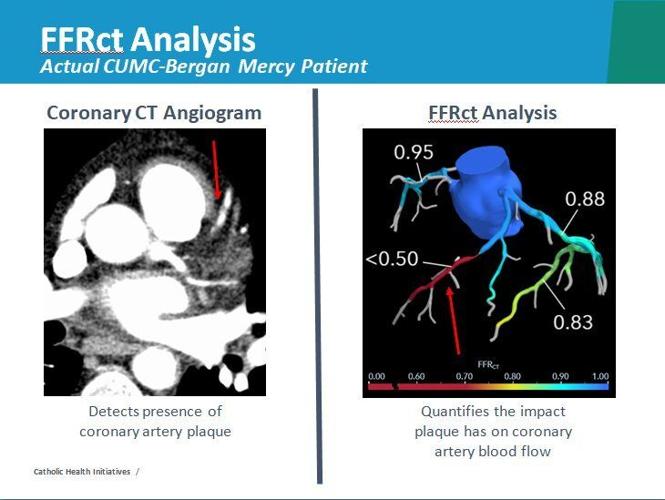 CHI Health helps with trial showing CT, flow analysis better for ...