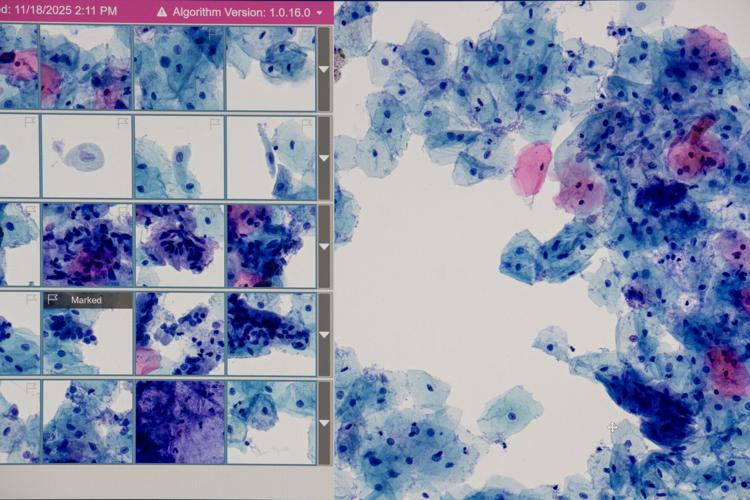 AI aids in cancer prevention tests at MUSC