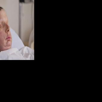 New face of chimpanzee attack victim revealed