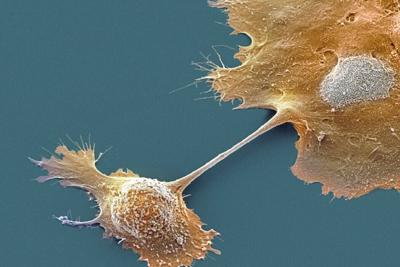 Breakthrough drug nearly doubles survival with advanced pancreatic ...
