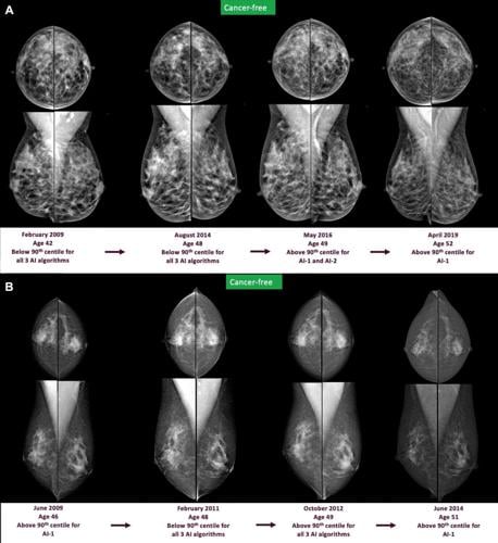 AI helps spot early warning signs of breast cancer sooner | Health ...