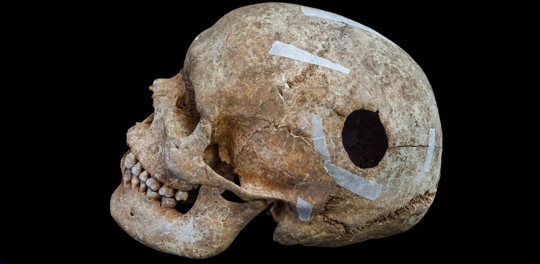 Viking-era skull gives glimpse of world’s first brain surgery ...