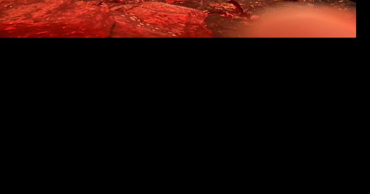 Bellows Falls teen rescued after 30 foot fall on Fall Mountain | Local ...