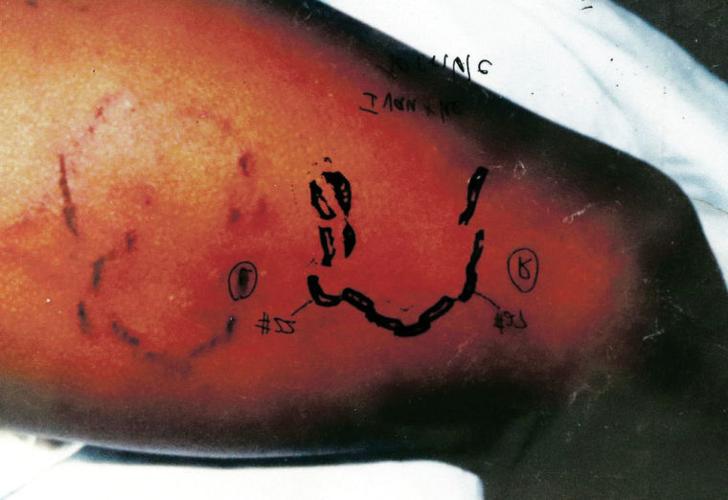ted bundy bite evidence