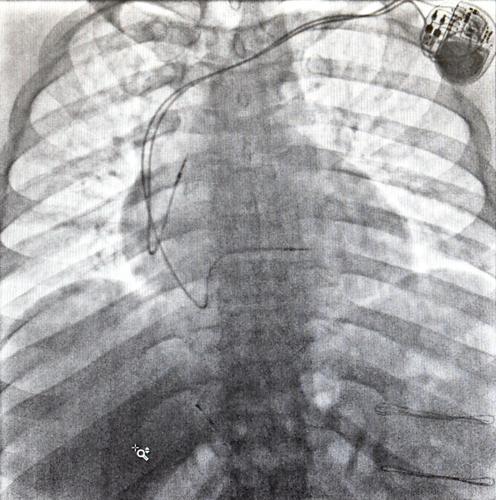 Pacemakers and defibrillators are devices that make a difference