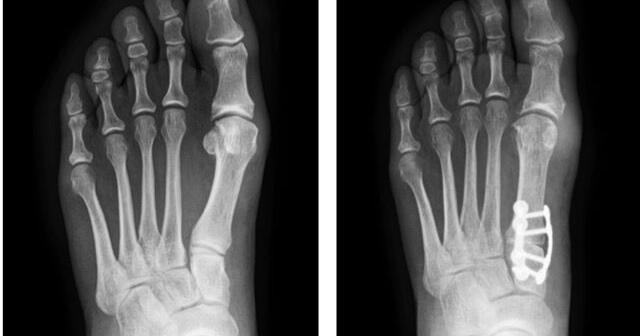 New 3D bunion procedure offers patients relief