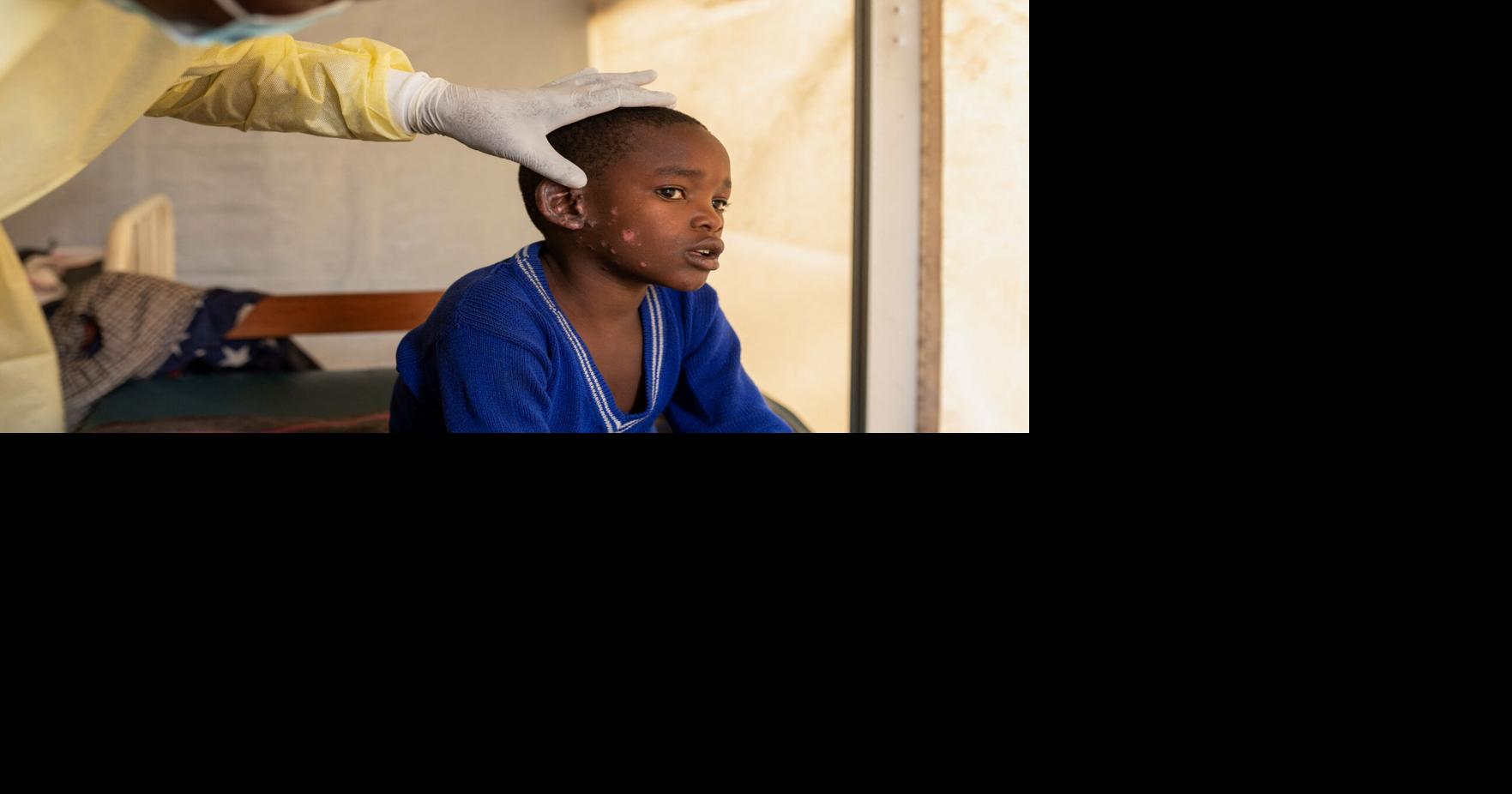 Who Declares Mpox Outbreaks In Africa A Global Health Emergency As A New Form Of The Virus