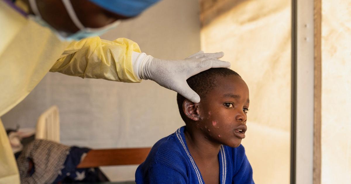 Who Declares Mpox Outbreaks In Africa A Global Health Emergency As A New Form Of The Virus