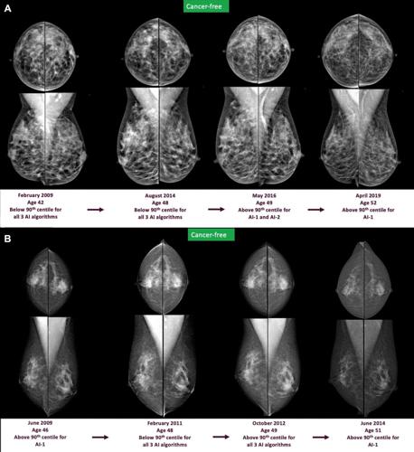 AI helps spot early warning signs of breast cancer sooner | Community ...