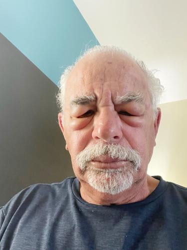 Bee sting survivor shares his story | News | southtexasnews.com