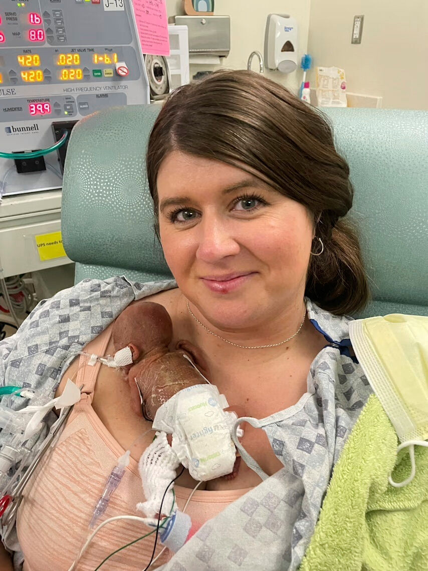 Baby born weighing 10 ounces sets record with 1st birthday