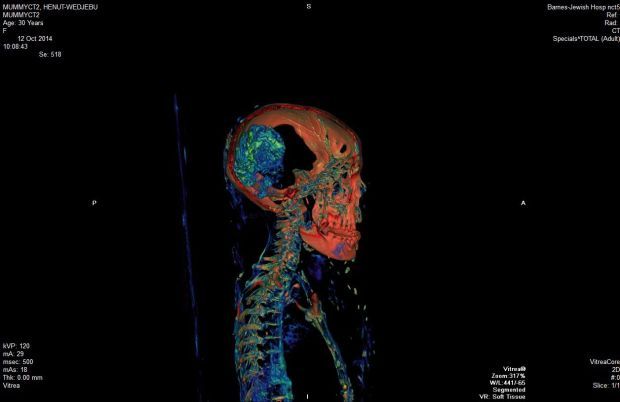 Mummies get a closer look at Barnes-Jewish