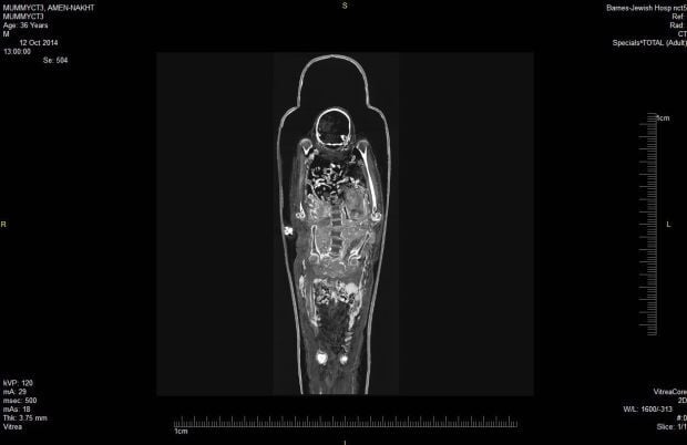 Mummies get a closer look at Barnes-Jewish