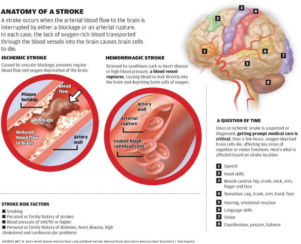 New stroke treatment could help prevent brain damage