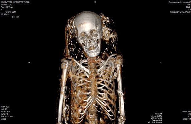 Mummies get a closer look at Barnes-Jewish