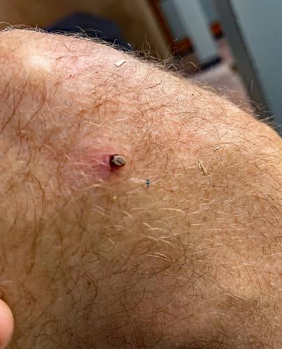 engorged tick bite