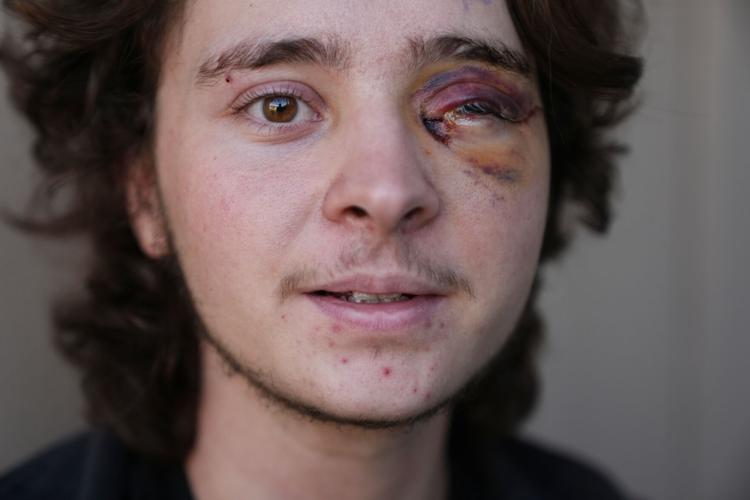 California protester left blind in one eye is among string of violent ...