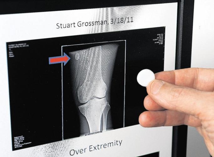 Implantable disk releases pain medication | Features | telegraphherald.com