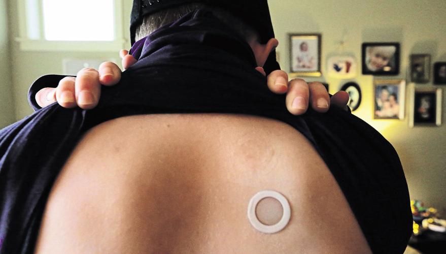 How a skin patch could be safe treatment for peanut allergies ...