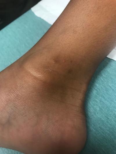 Mom: Student complaining of snake bite waited 4 hours before Dutchtown ...