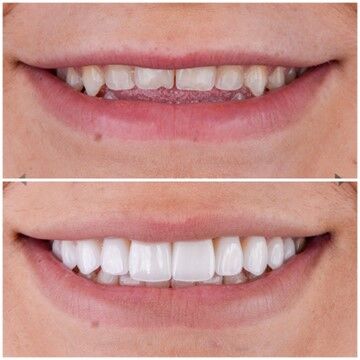 Sponsored: Porcelain veneers at Pearl Dental Group | Sponsored: Pearl ...