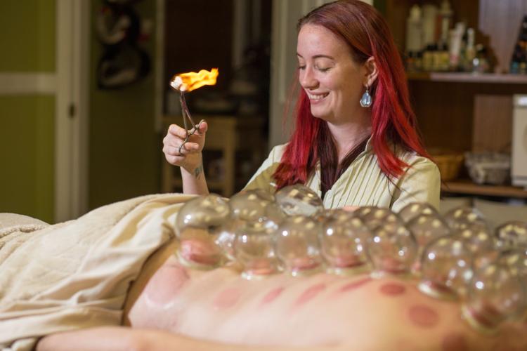Olympics pushes cupping therapy into spotlight | Health Fitness ...