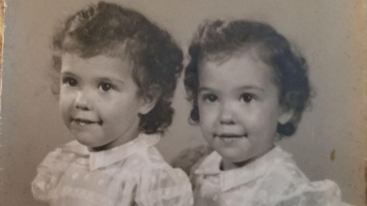 Conjoined Mouton twins from Lafayette, La survived surgery ...