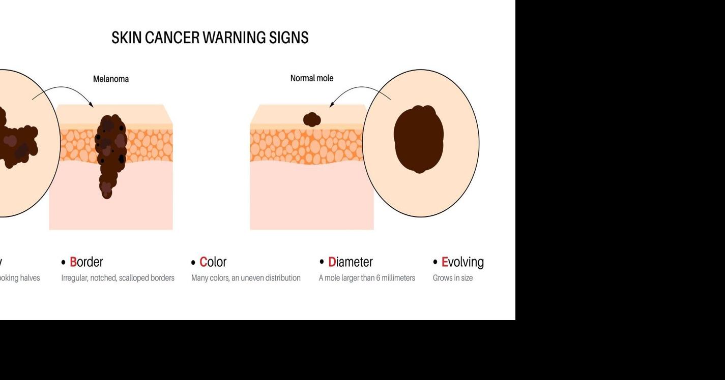 Spot something? A guide to melanoma | Health | theleadernews.com