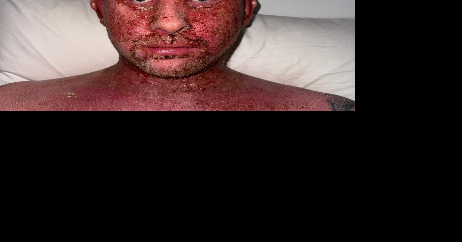 Man left with burning, oozing skin due to steroid cream | Health ...