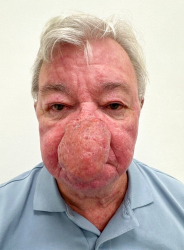 Man undergoes life-changing surgery for massive nose growth | Health ...