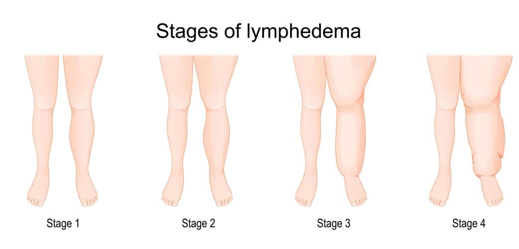 Understanding Lymphedema: Causes, symptoms, and management | Health ...