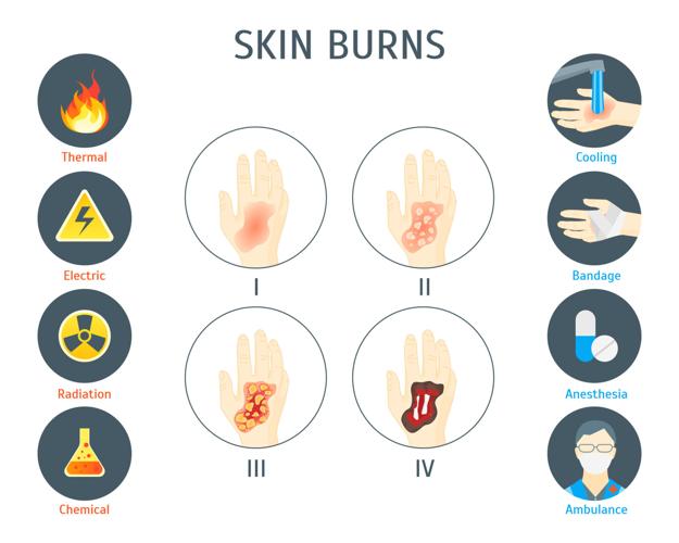 The best way to treat a burn | Health | themountaineer.com