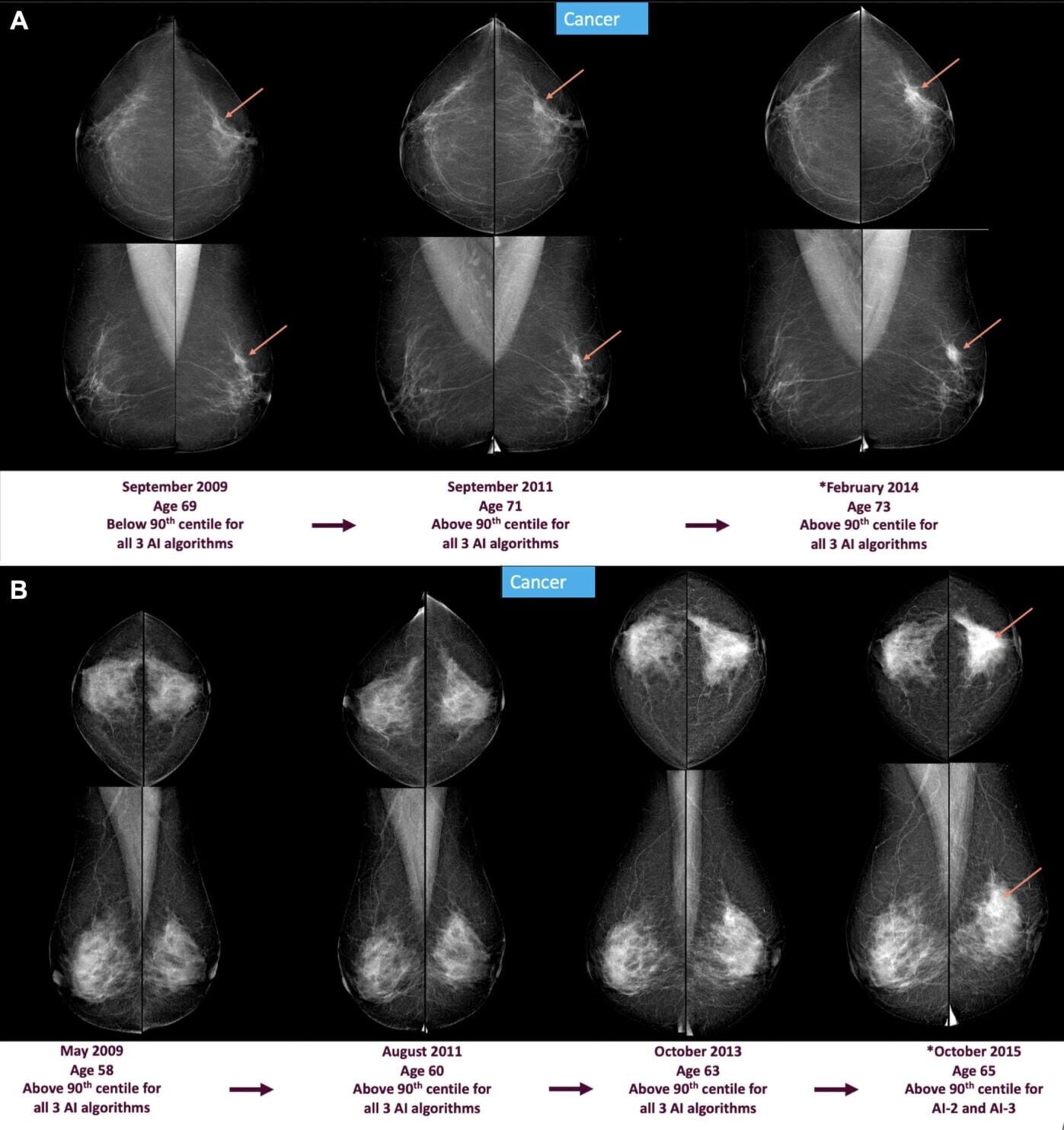 AI helps spot early warning signs of breast cancer sooner | Health ...
