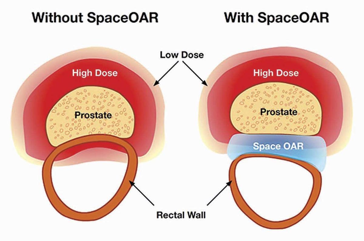 New prostate cancer option available at HMH | Local News ...