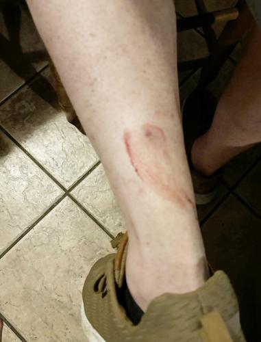 copperhead bite human