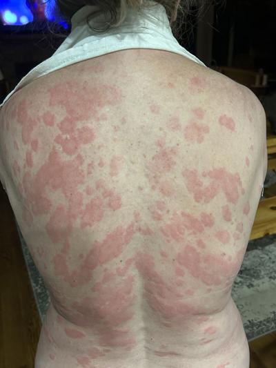Alpha Gal Syndrome From Tick Bites Growing More Common Sports