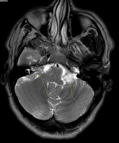 Man’s hearing loss turns out to be a rare brain tumor | Health ...