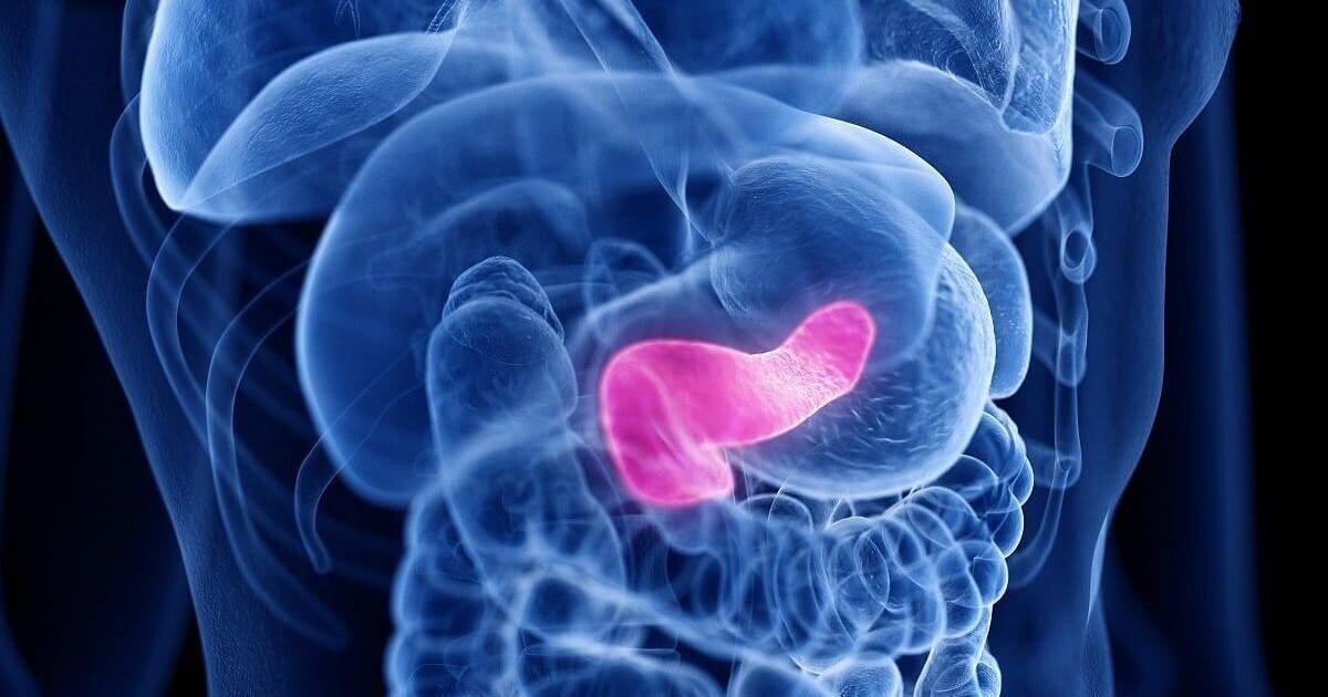Risk Score Helps Predict Pancreatic Cancer Recurrence, Study Says ...