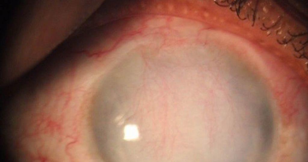 Shingles of the eye | Local News | trinidadexpress.com