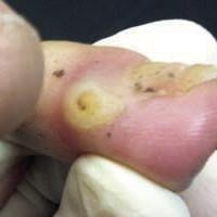 Plagued by interdigital corns | Local News | trinidadexpress.com