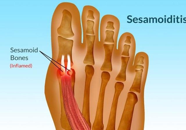 Big toe joint injuries | Features Local | trinidadexpress.com