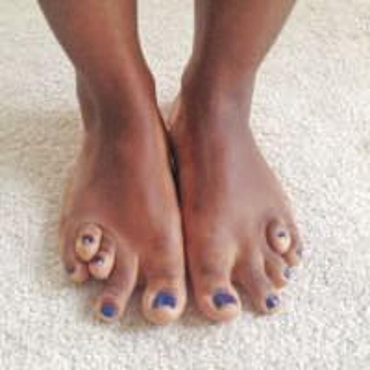 dwarfism toes
