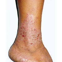 What is varicose eczema | Local News | trinidadexpress.com